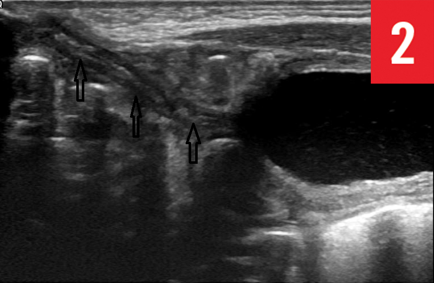 Urachus Ultrasound 5055